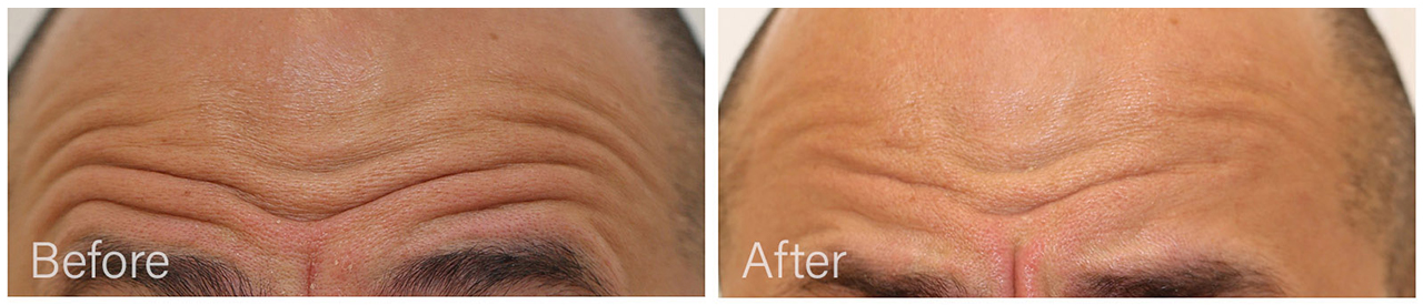 Botox Virginia Beach | Best Botox in Virginia Beach