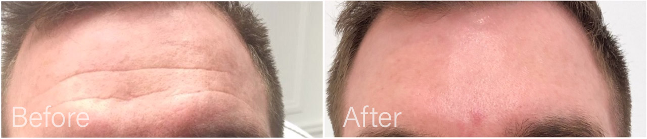 Botox Virginia Beach | Best Botox in Virginia Beach